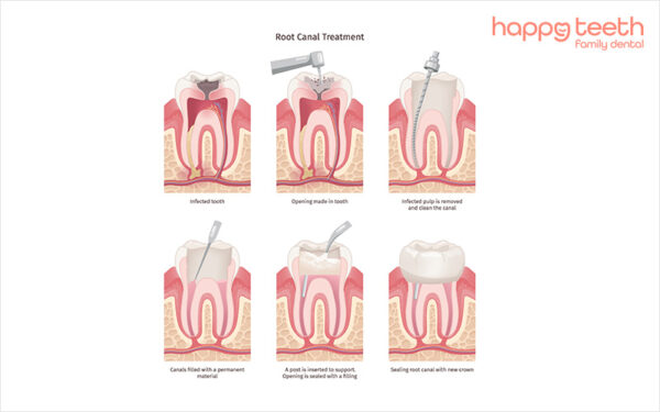 A Detailed Guide to Root Canal Procedures | Happy Teeth Family Dental